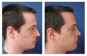 Closed Rhinoplasty Incisions | Cosmetic Plastic Surgery Institute