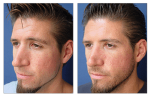 Crooked Nose Bridge | Cosmetics Surgery | Beverly Hills