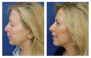 Fat Transfer for Lower Eyelids | Cosmetic Plastic Surgery Institute